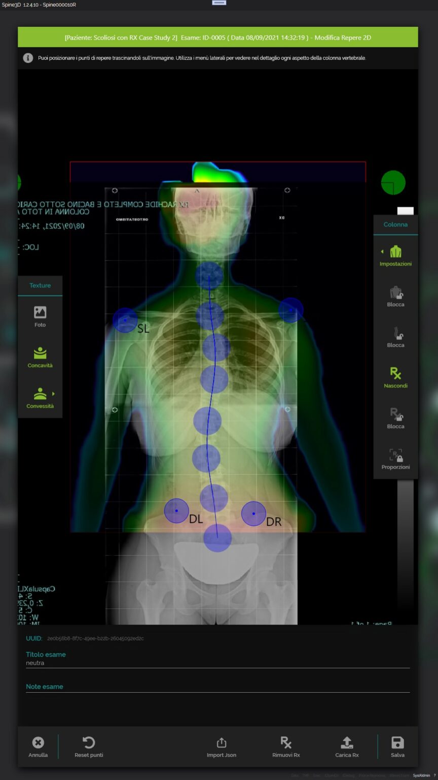 Non-invasive 3D scan of the spine - Posture Analysis