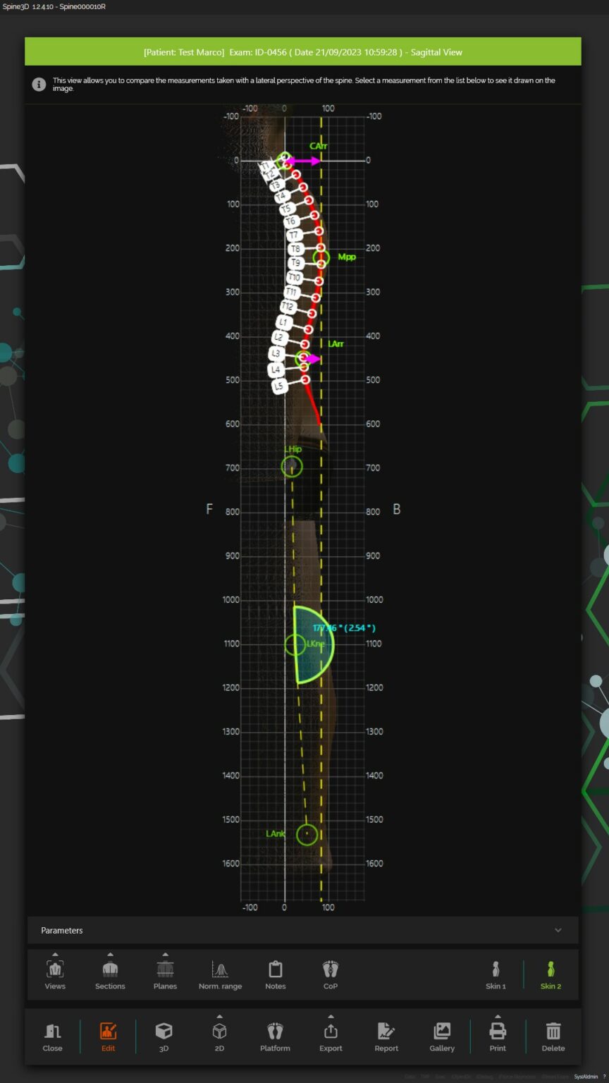 Non-invasive 3D scan of the spine - Posture Analysis