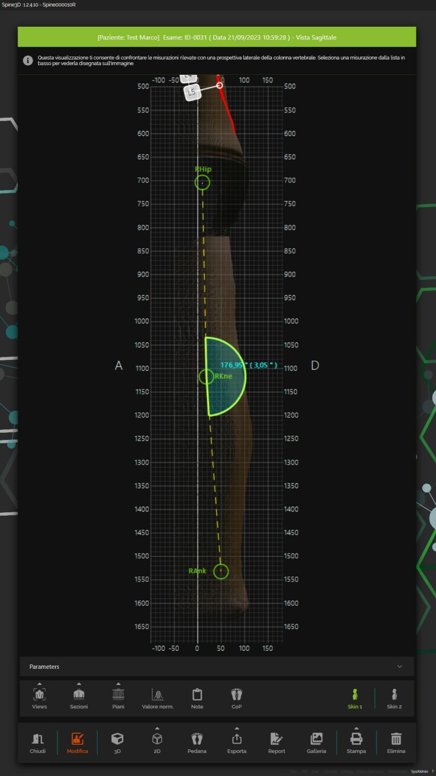 Non-invasive 3D scan of the spine - Posture Analysis